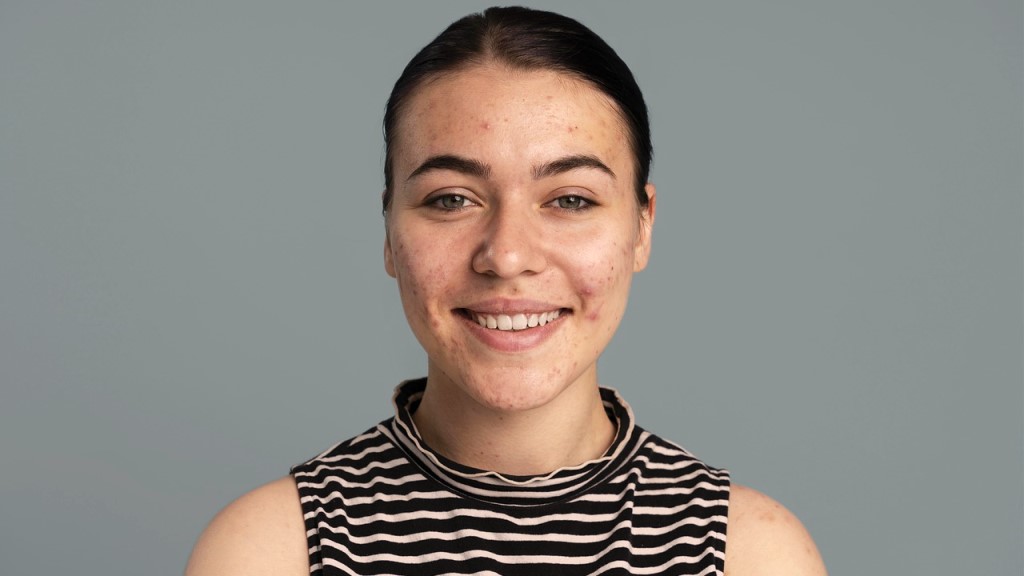 Jerawat di Hidung Bikin Minder, Pahami Penyebab, Jenis, dan Cara ...