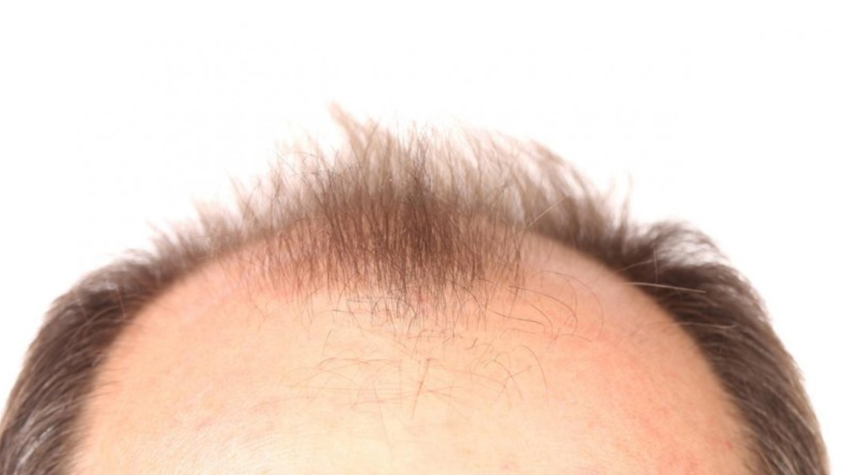 8 Penyebab Kebotakan Rambut dan Cara Mengatasinya Menggunakan Bahan Bumbu Dapur – Radartasik.id